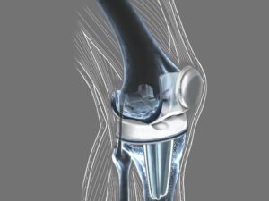 Protesi Articolari – Fisioterapia Torino – Clinica Motus